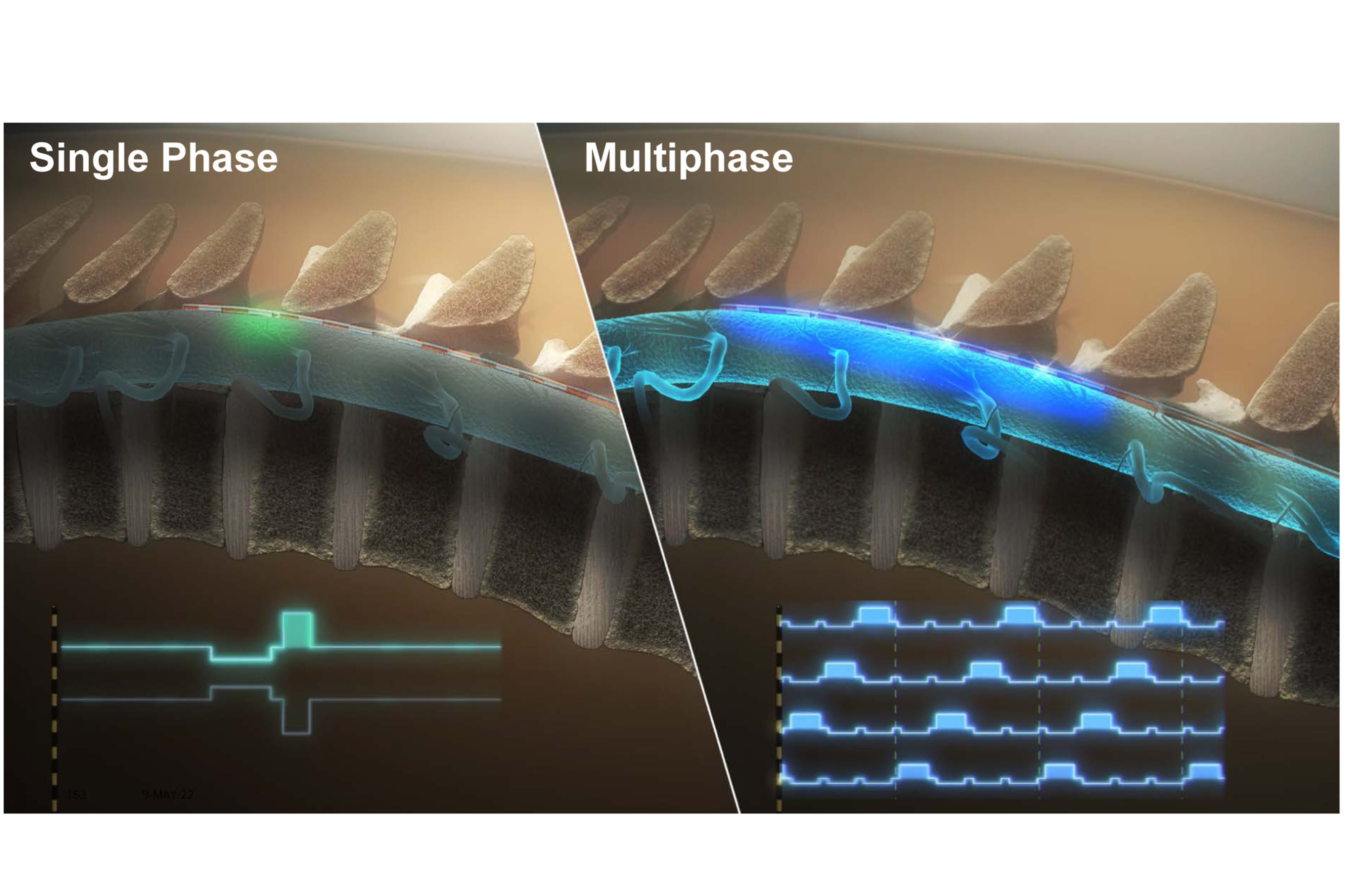 BENEFIT-01 Study Now Published in Neuromodulation: A Glimpse into the Future of Spinal Cord ...
